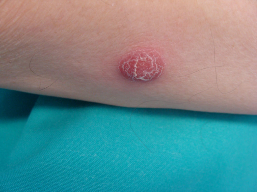 Lesión nodular de rápido crecimiento en el brazo | Piel. Formación ...