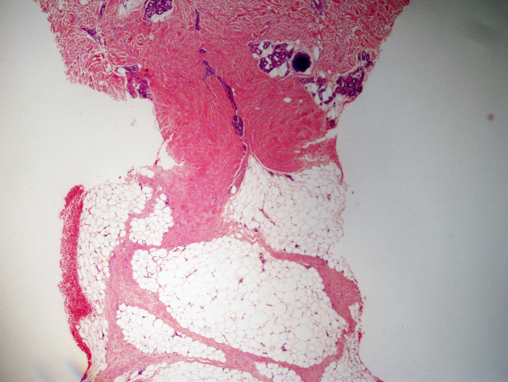 Morfea profunda | Piel. Formación continuada en dermatología