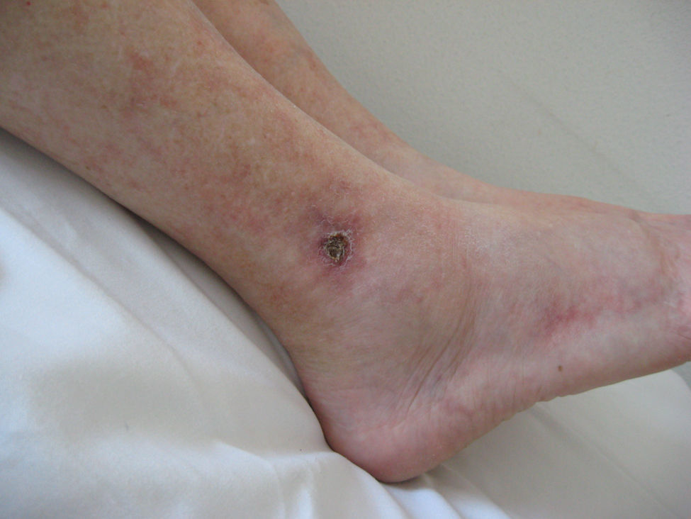 Vasculopatía livedoide | Piel. Formación continuada en dermatología