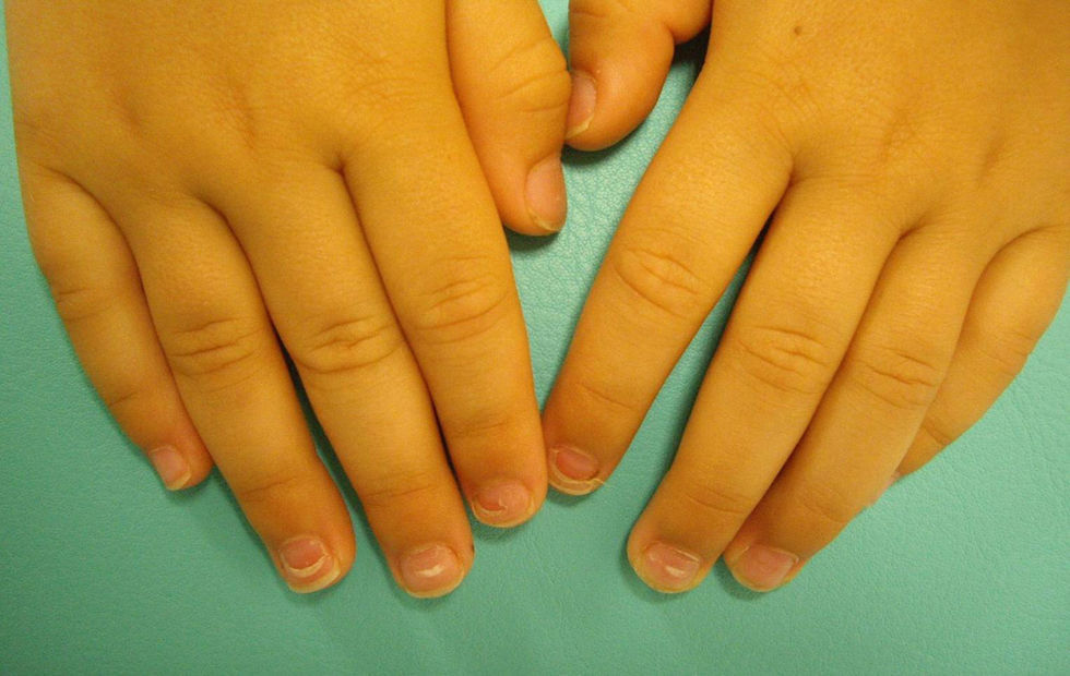 Onicomadesis de las uñas de ambas manos en niño de 4 años | Piel ...