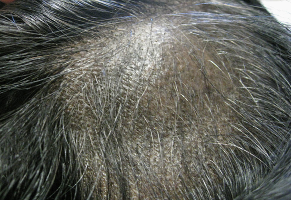 Nódulo de lento crecimiento en cuero cabelludo | Piel. Formación ...