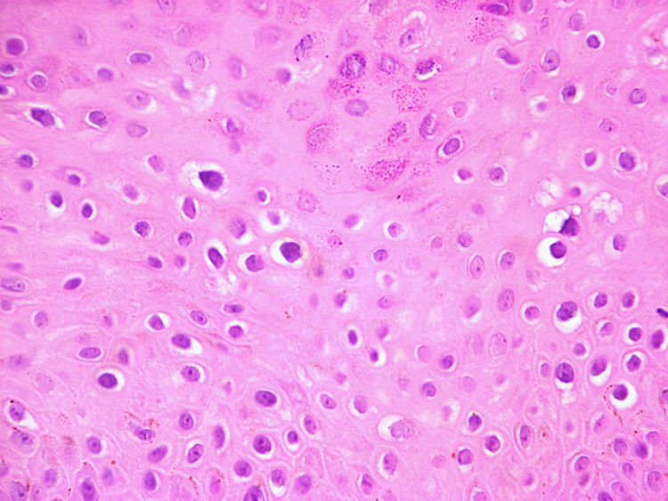 Condiloma acuminado alrededor de la ileostomía | Piel. Formación ...