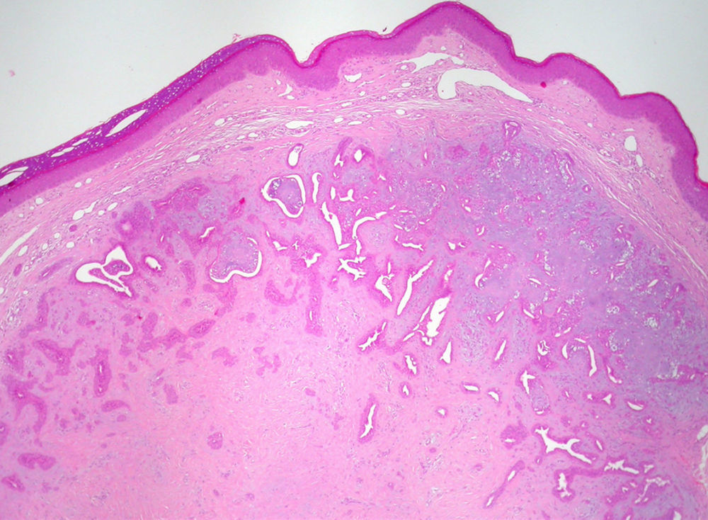 Nódulo asintomático en ala nasal | Piel. Formación continuada en ...