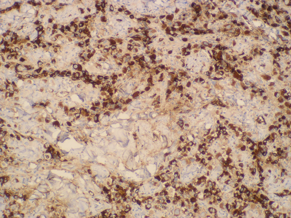 Mujer de 61 años con nódulo en cicatriz de laparatomía de reciente ...