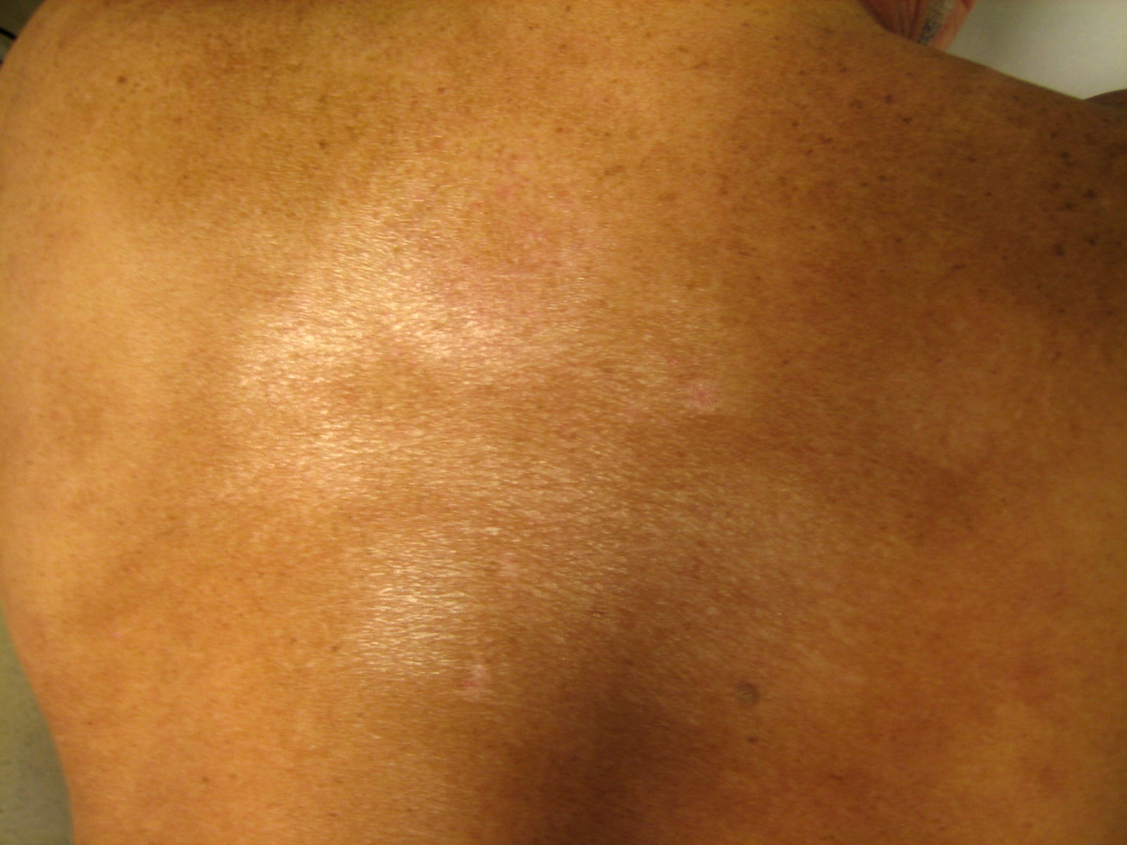 Esclerosis cutánea progresiva de tronco y miembros en un paciente ...