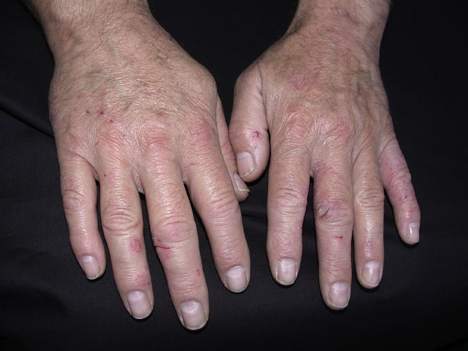 Sensibilización a formaldehído y sus liberadores en dermatología ...