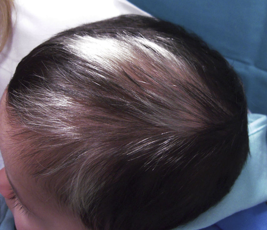 Mechón blanco frontal aislado | Piel. Formación continuada en dermatología