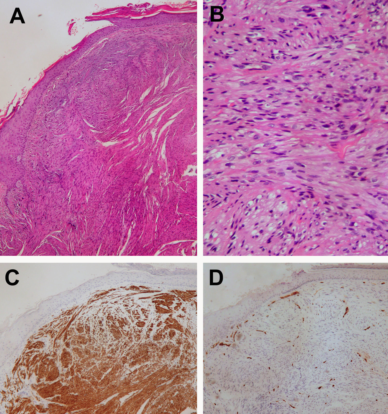 Nódulo de rápido crecimiento en brazo derecho | Piel. Formación ...