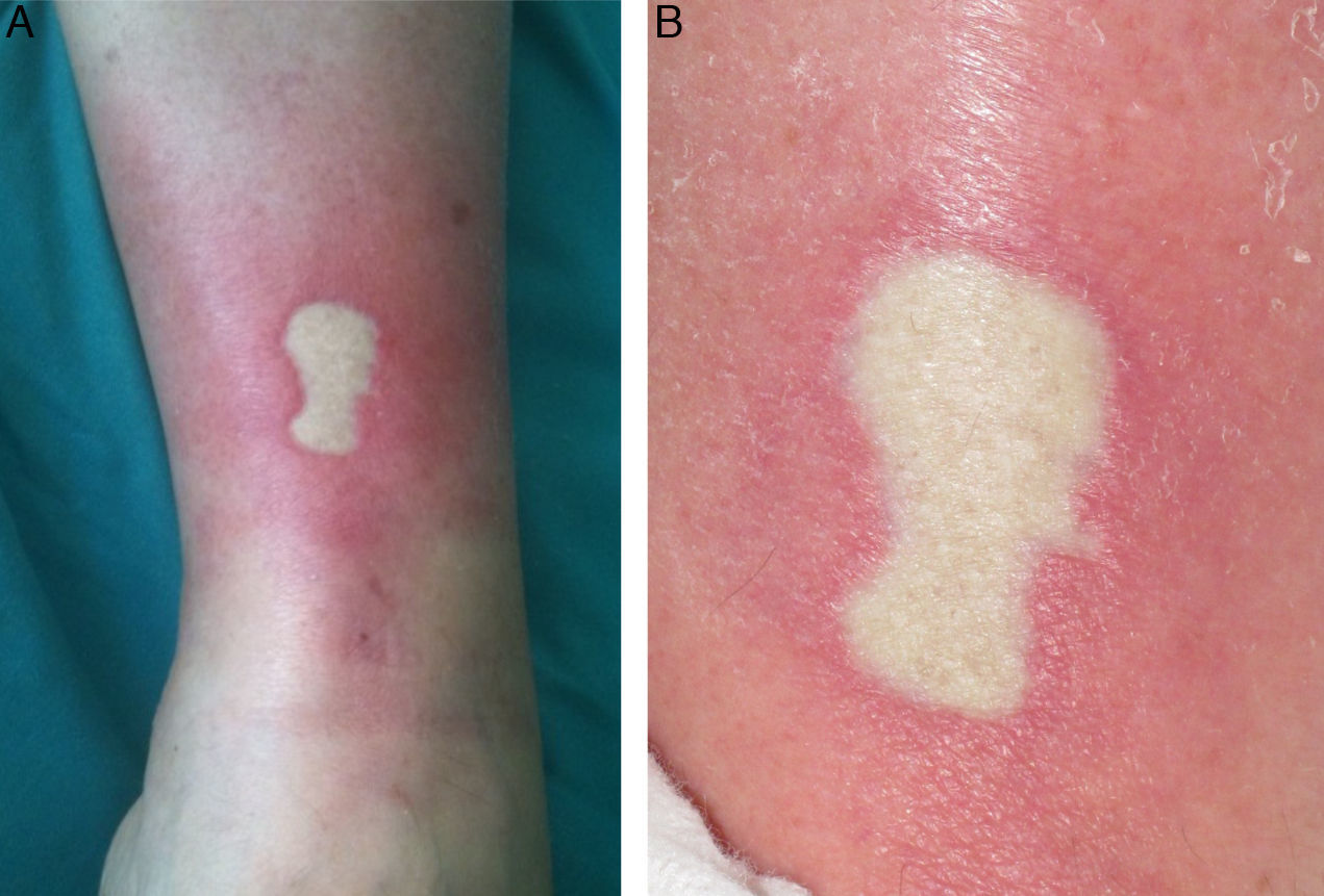 Necrosis cutánea por vancomicina | Piel. Formación continuada en ...