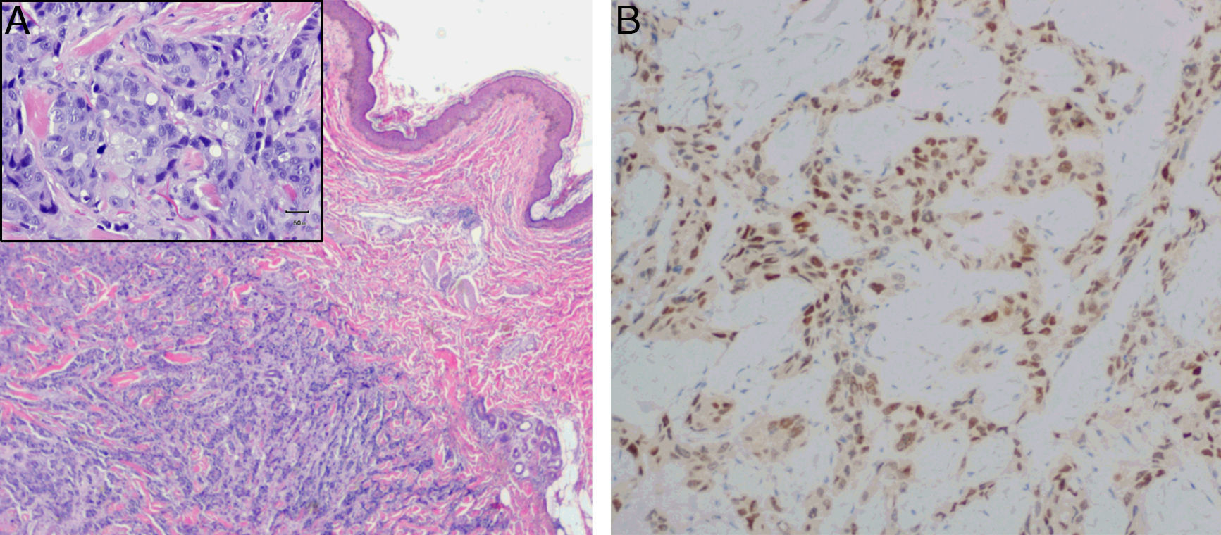Cervicalgia aguda y nódulo cutáneo como primera manifestación de un ...
