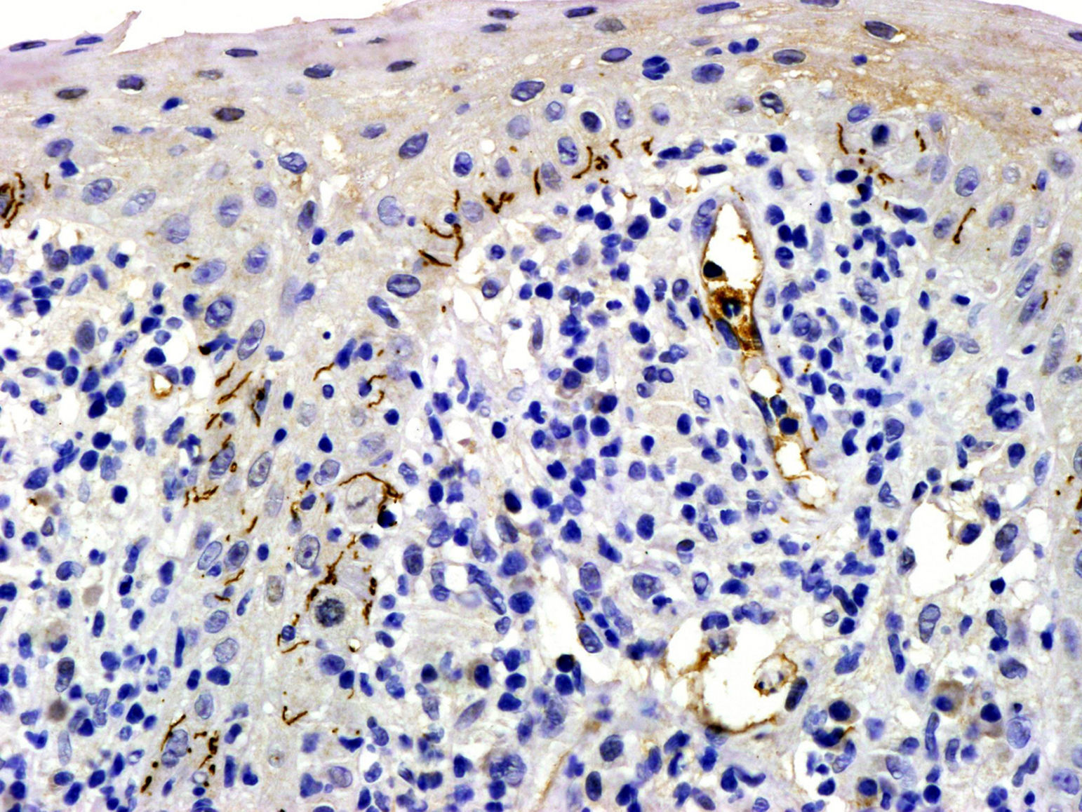 Sífilis maligna en paciente VIH positivo | Piel. Formación continuada ...