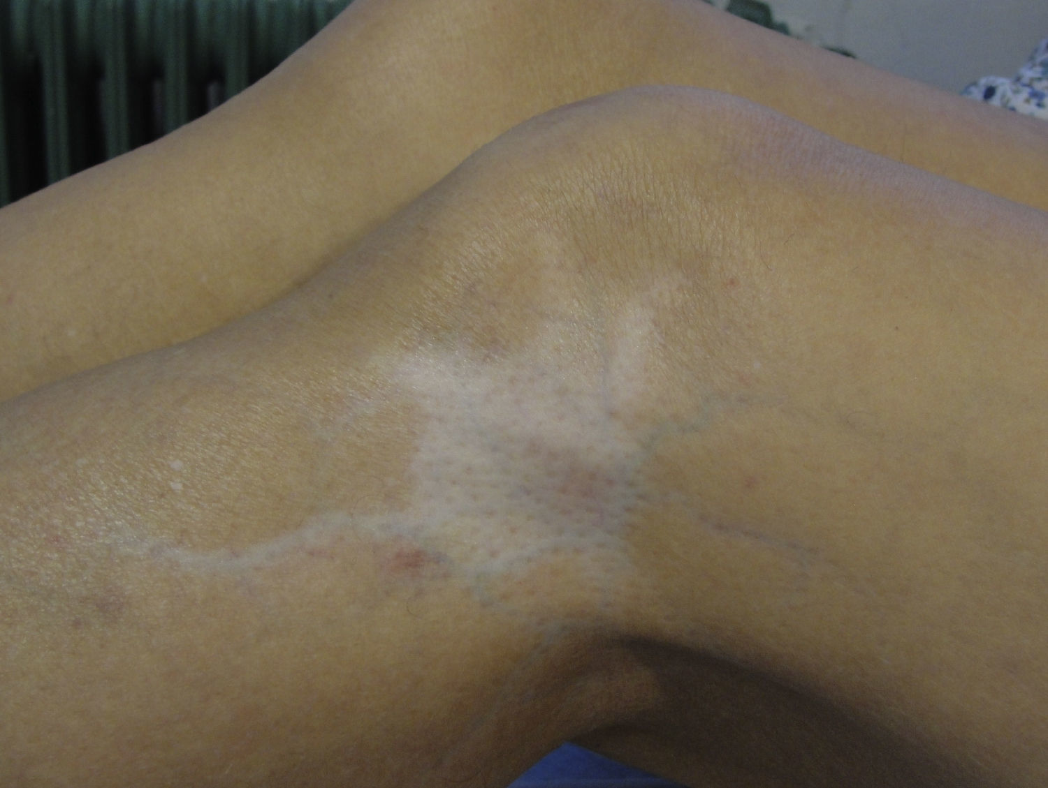 Hipopigmentación lineal y atrofia cutánea secundarias a infiltración de ...