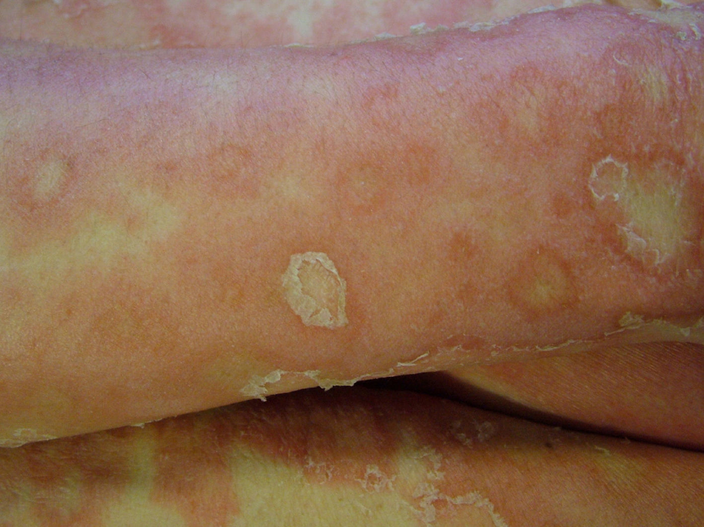 Pustulosis exantemática generalizada aguda debida a hidroxicloroquina ...