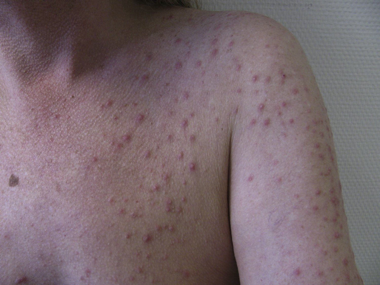 Diagnóstico diferencial de la candidiasis sistémica | Piel. Formación ...