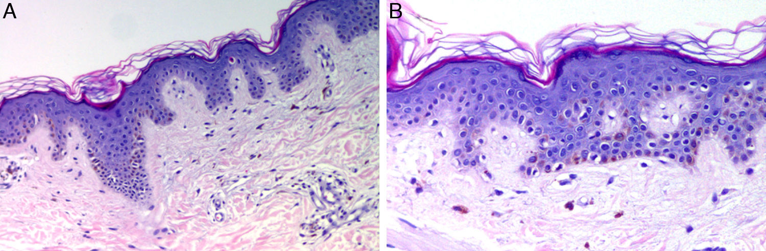 Nevo lentiginoso lineal | Piel. Formación continuada en dermatología