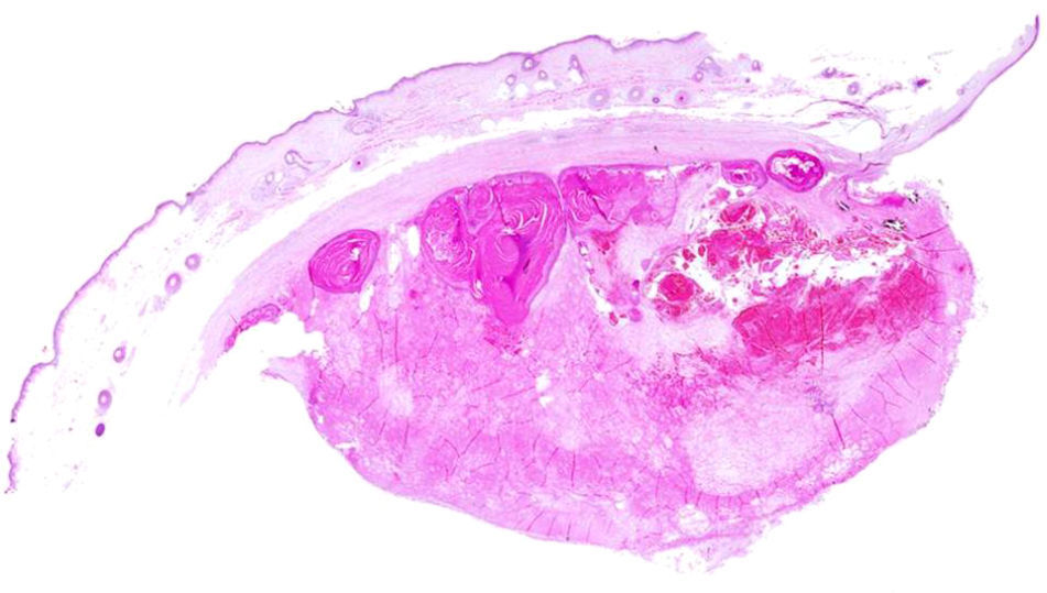 Quiste triquilemal proliferante | Piel. Formación continuada en ...
