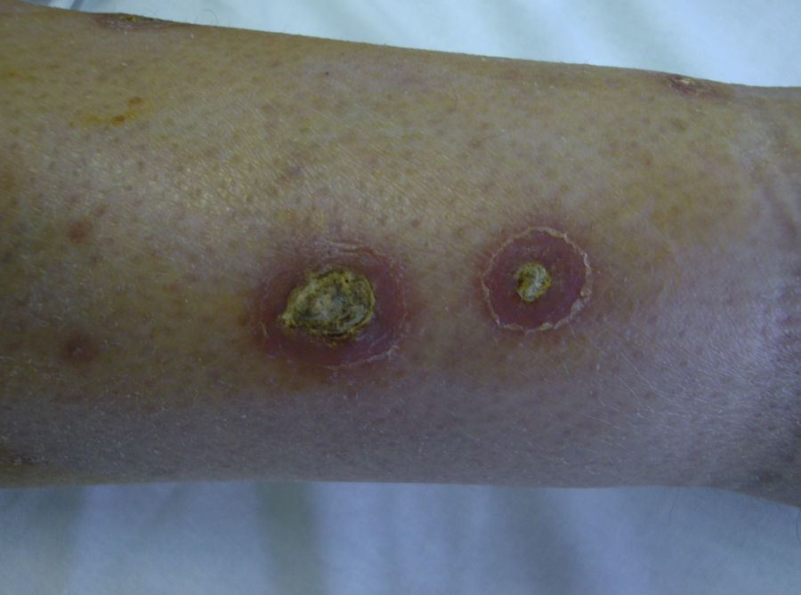 Lesiones costrosas en los miembros inferiores | Piel. Formación ...