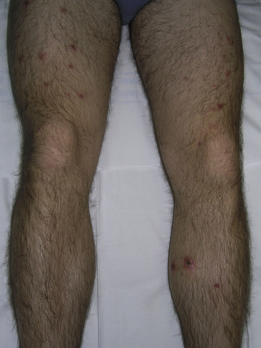 escoriaciones multiples