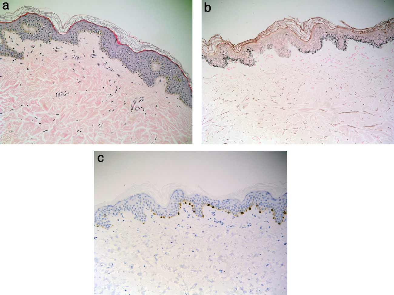 Leucodermia punteada en adolescente tras tratamiento con ...