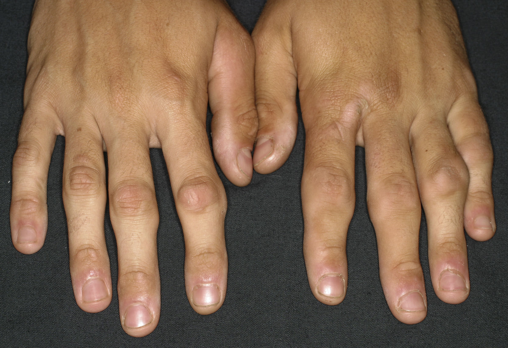 Nódulos subcutáneos en las manos | Piel. Formación continuada en ...