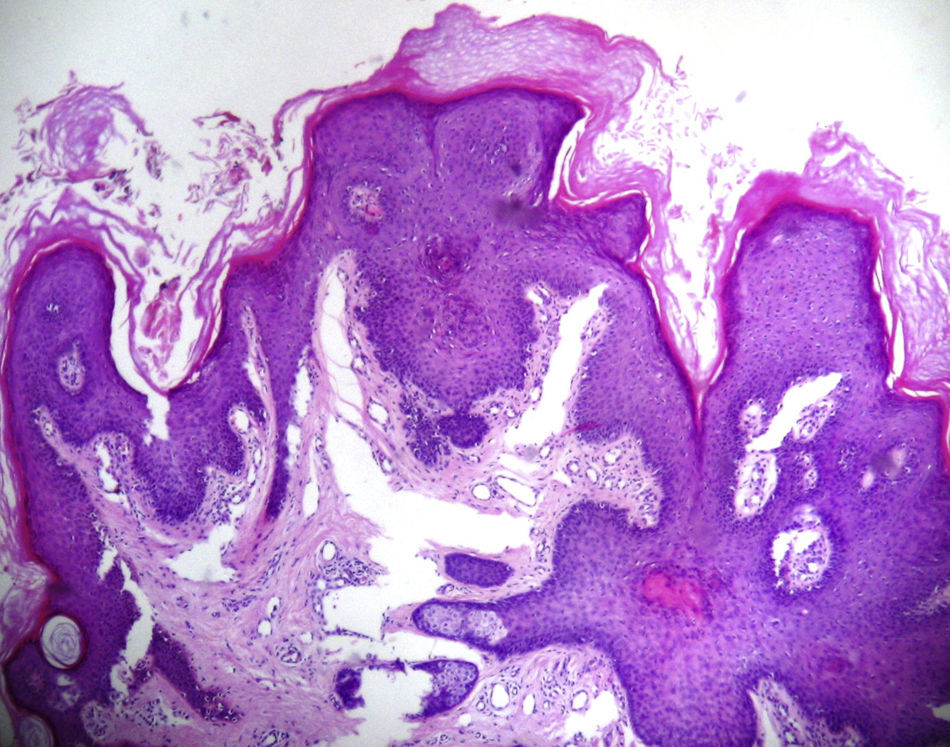 Nevo epidérmico verrugoso dividido en la oreja | Piel. Formación ...