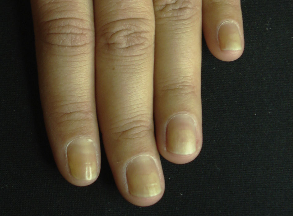 Foto-onicólisis y foto-ónico pigmentación inducida por doxiciclina ...