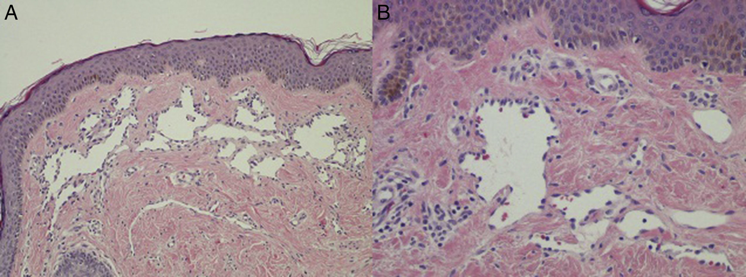 Pápula rojiza cambiante en el hombro de una mujer | Piel. Formación ...