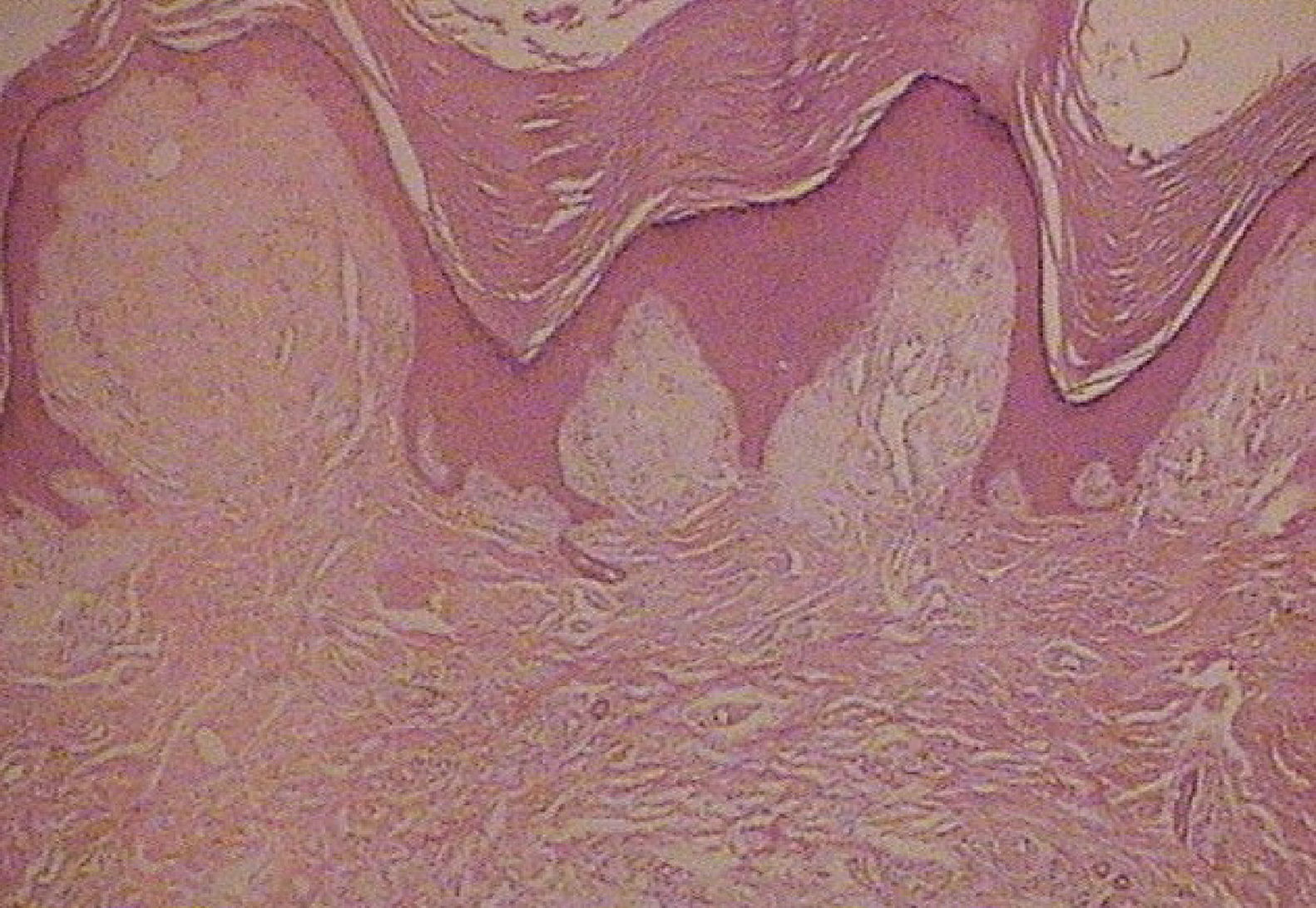 Hiperqueratosis digitada diminuta múltiple | Piel. Formación continuada ...