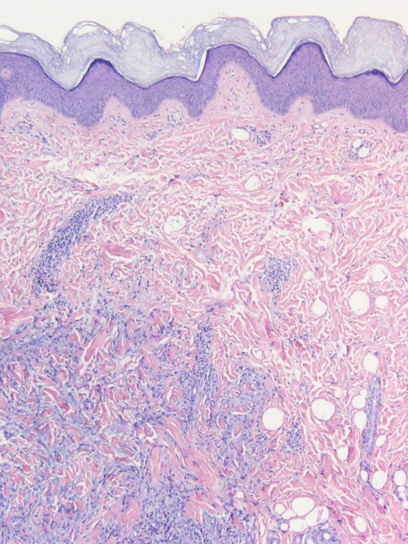 Nódulo doloroso acral en una mujer adulta con dislipemia | Piel ...