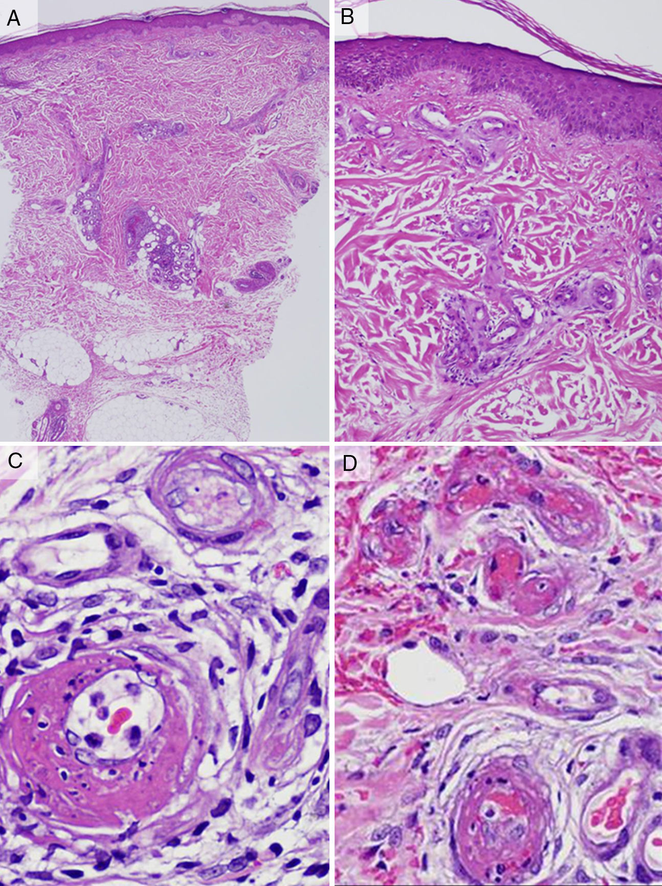 Experiencia con bosentan en el tratamiento de una paciente con ...