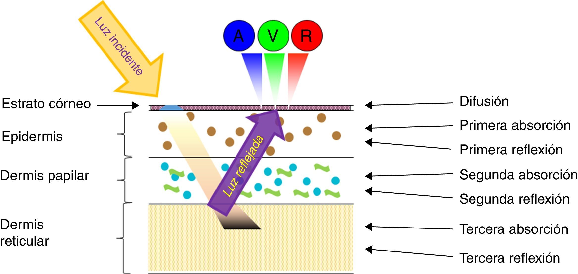 Utilidad de la siascopia en el diagnóstico de lesiones melanocíticas ...