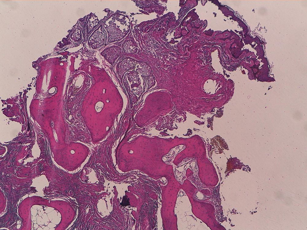 Osificación cutánea secundaria en un nevo de Becker | Piel. Formación ...