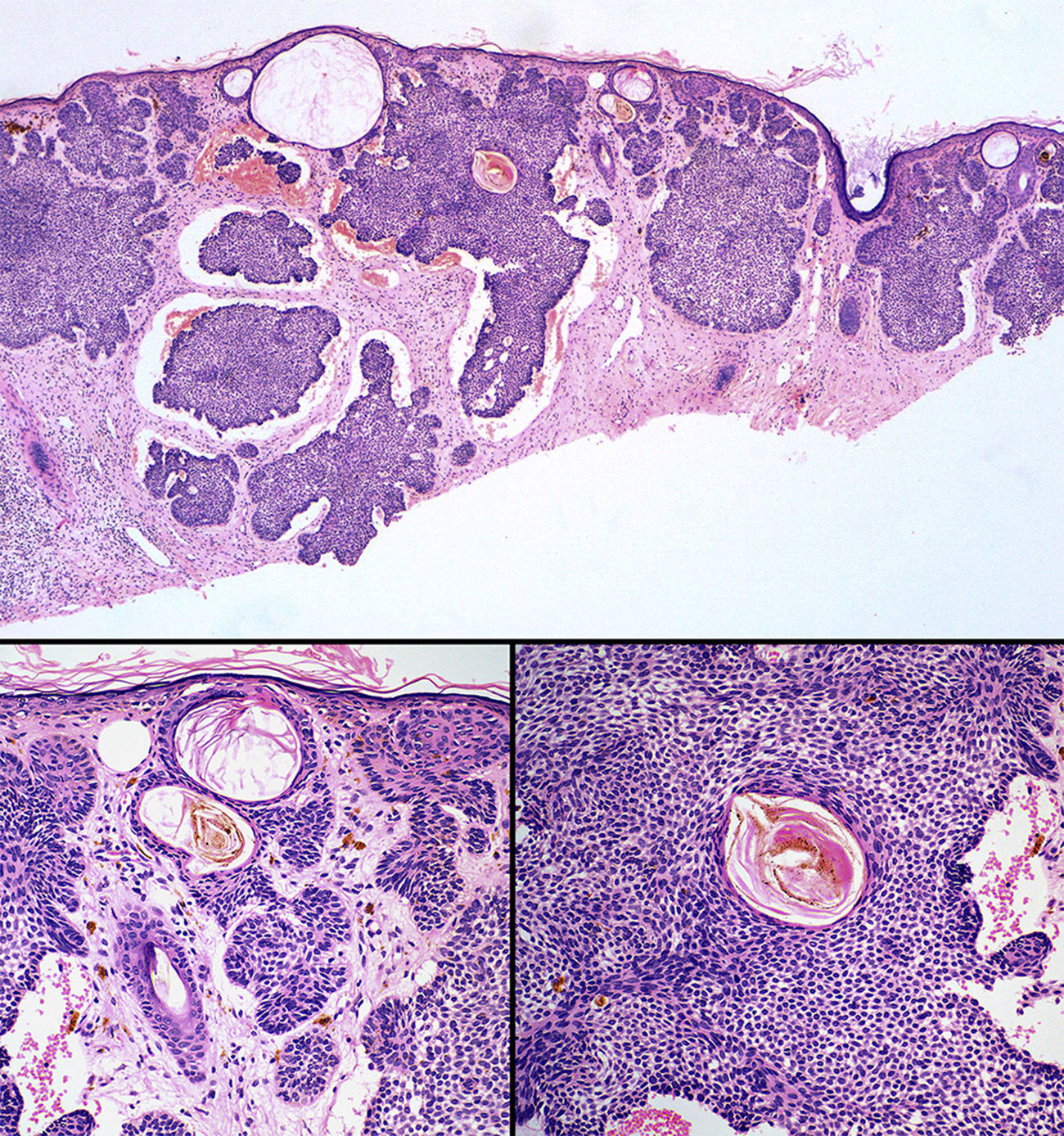 Pápula pigmentada nasal | Piel. Formación continuada en dermatología