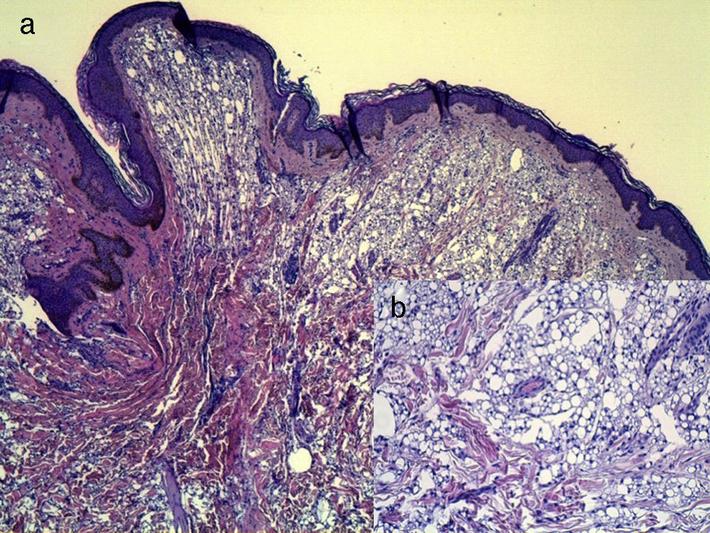 Placas induradas en la zona interglútea | Piel. Formación continuada en ...