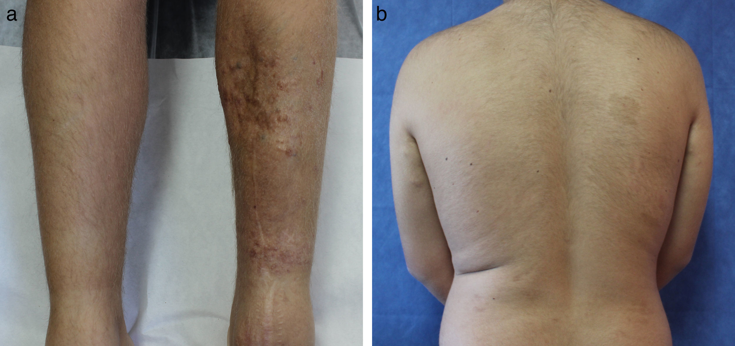 Síndrome de McCune-Albright | Piel. Formación continuada en dermatología