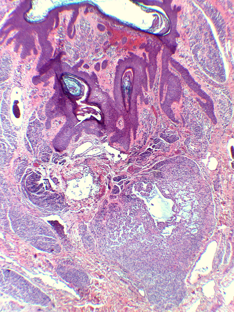 Nevo melanocítico intradérmico mucinoso | Piel. Formación continuada en ...