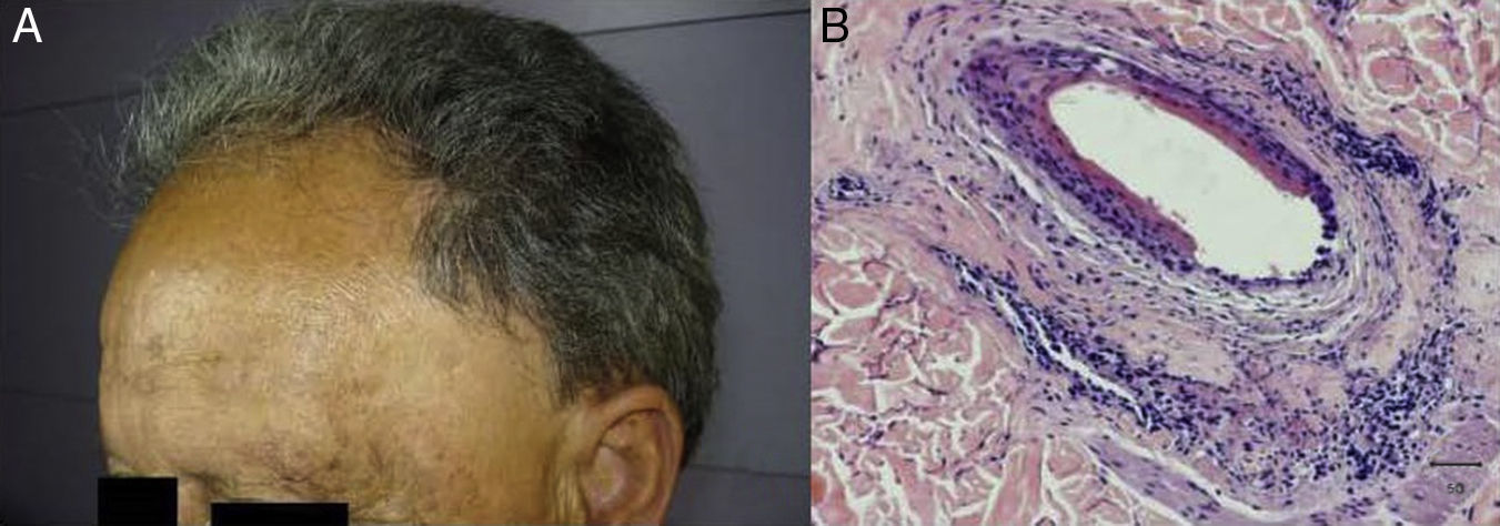 Alopecia frontal fibrosante en un varón asociada a liquen plano cutáneo ...