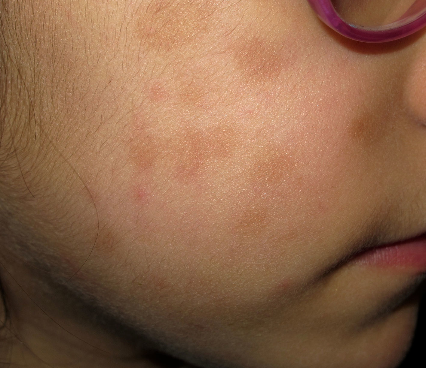 Máculas hiperpigmentadas faciales. Diagnóstico diferencial | Piel ...