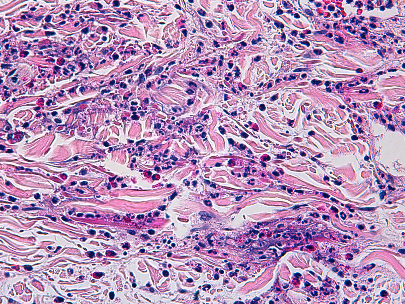 Placa eritematosa recidivante en una mujer adulta | Piel. Formación ...