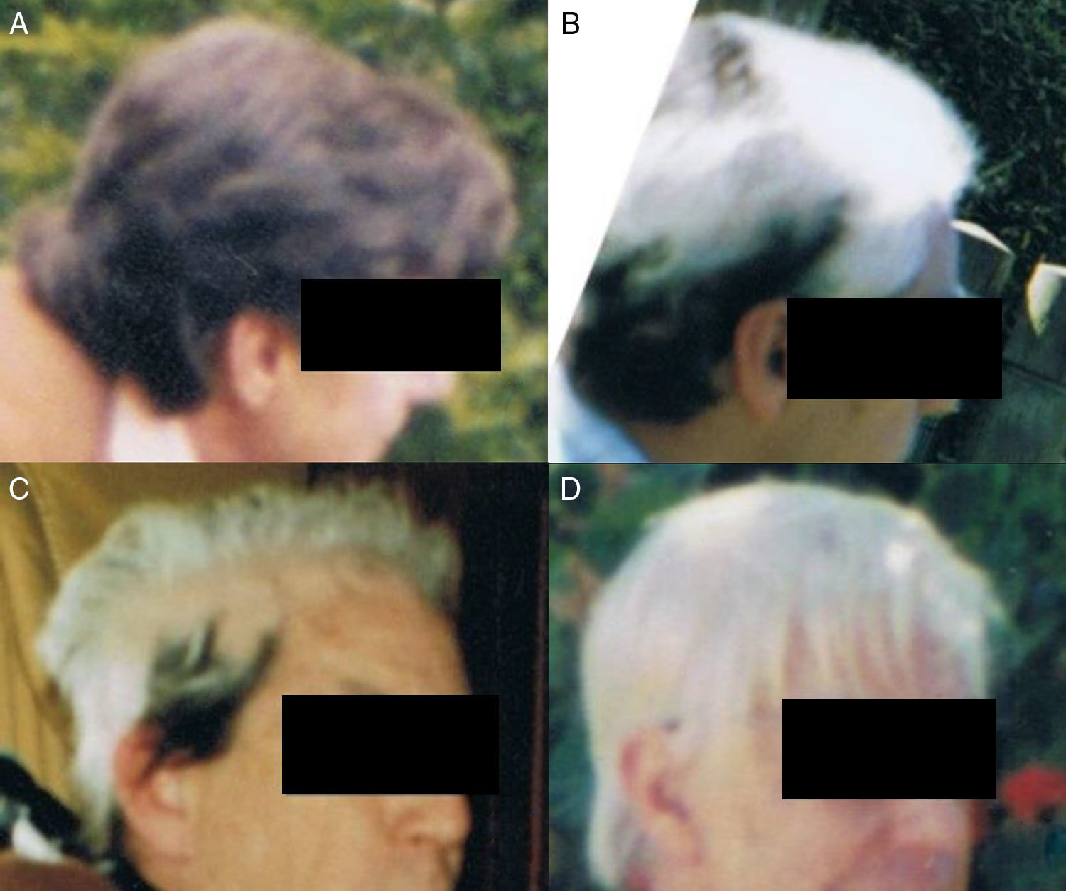 Síndrome de María Antonieta, un raro caso de canicie súbita | Piel ...