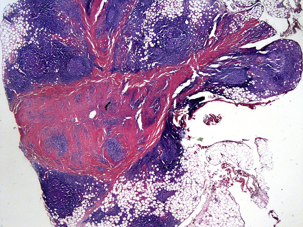 Nódulo persistente en el área deltoidea | Piel. Formación continuada en ...