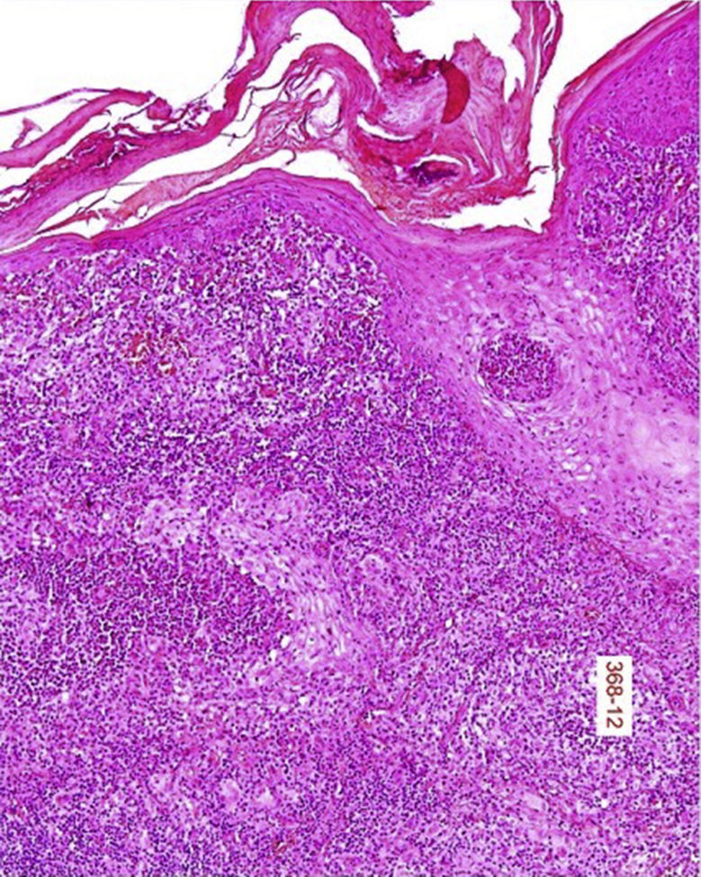Botriomicosis cutánea, un reto diagnóstico | Piel. Formación continuada ...