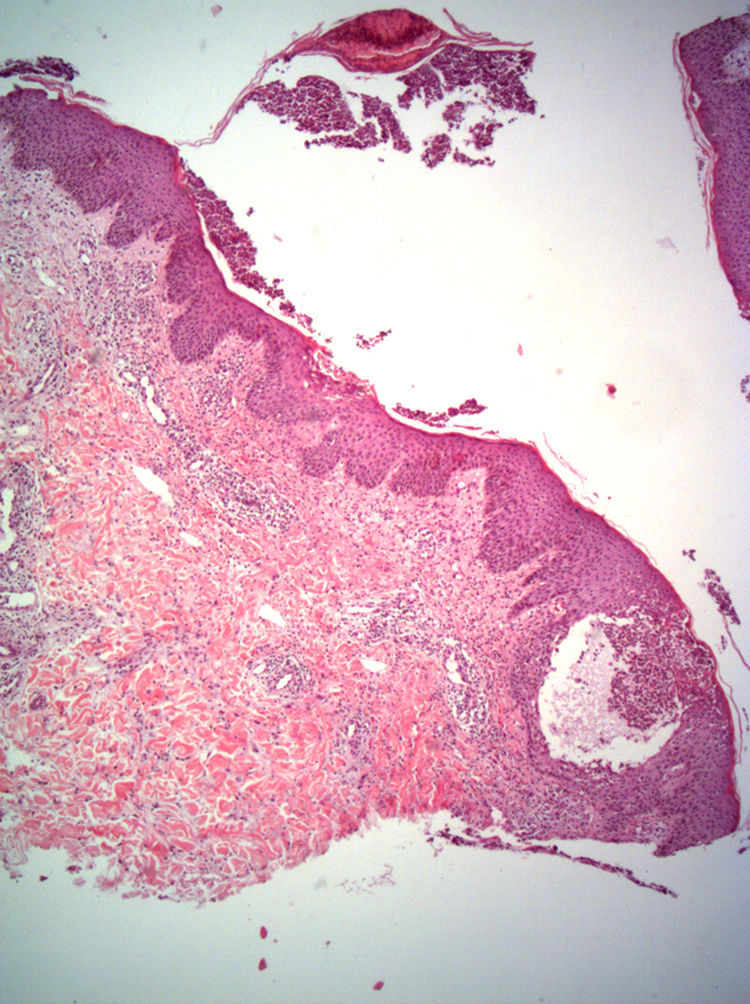 Impétigo herpetiforme (psoriasis pustulosa del embarazo): comunicación ...