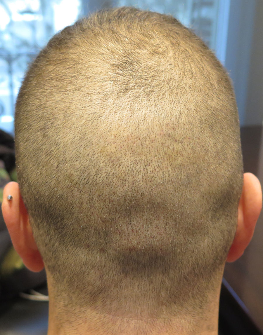 Novedades en el trasplante de pelo | Piel. Formación continuada en ...