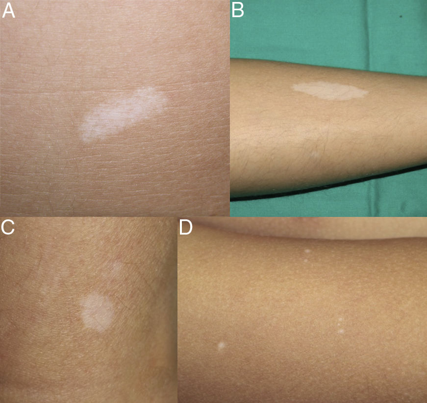 Diagnóstico y tratamiento de la esclerosis tuberosa | Piel. Formación ...