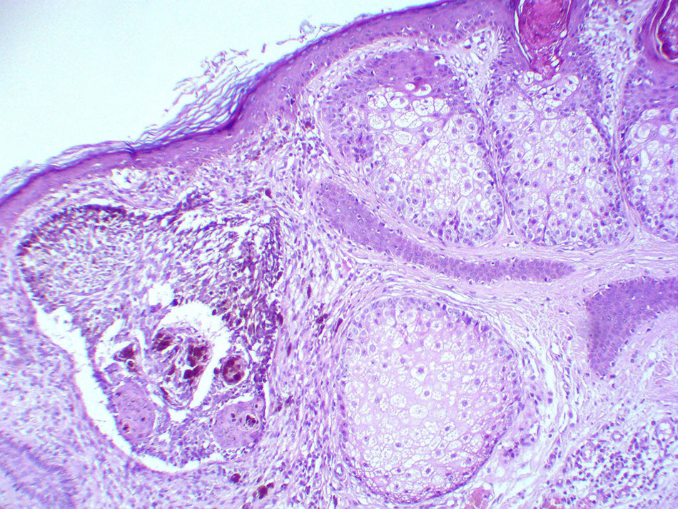 Nevus sebáceo asociado a carcinoma basocelular multifocal con ...