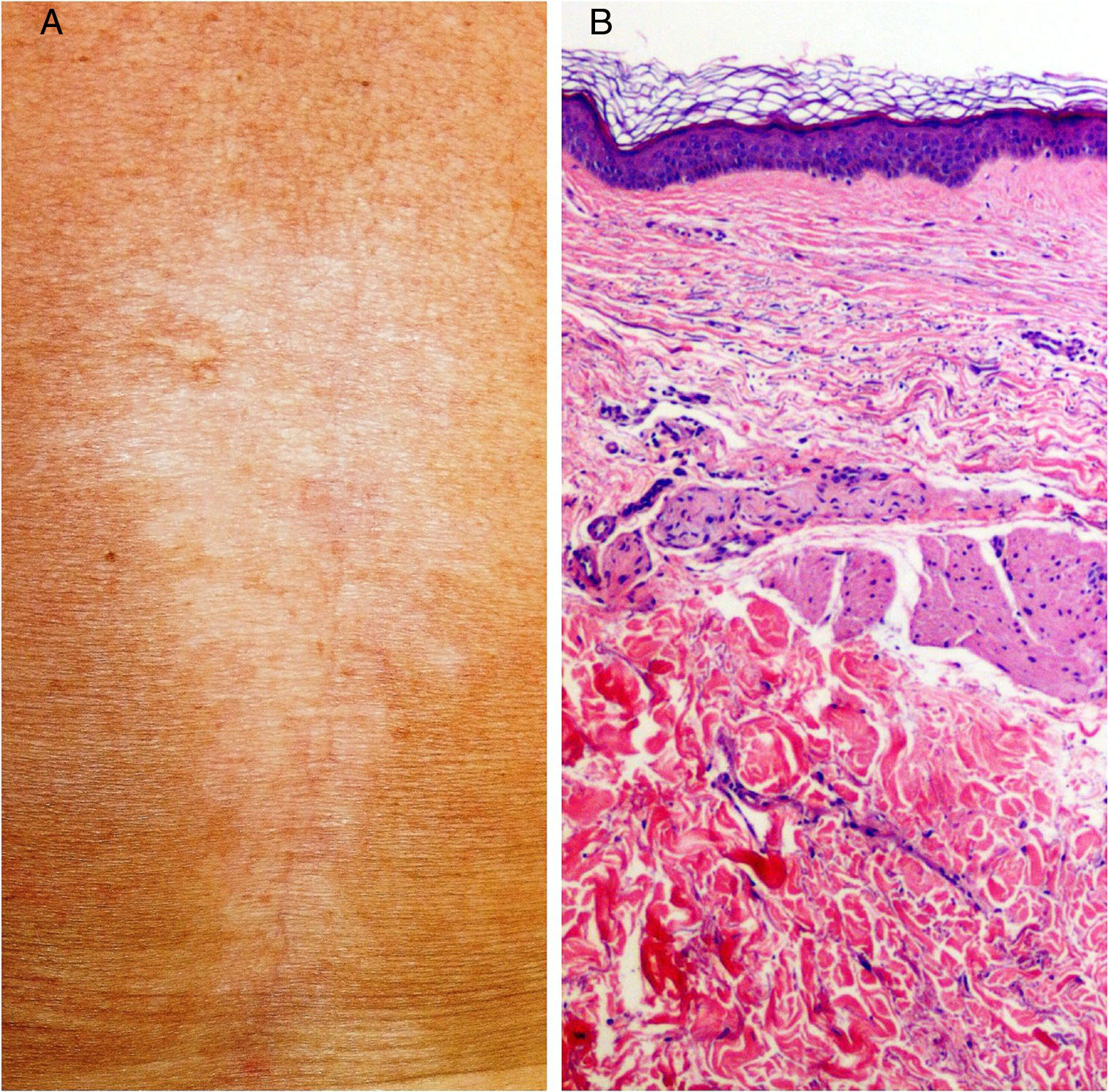 Coexistencia de morfea y granuloma anular, ¿un origen común? | Piel ...