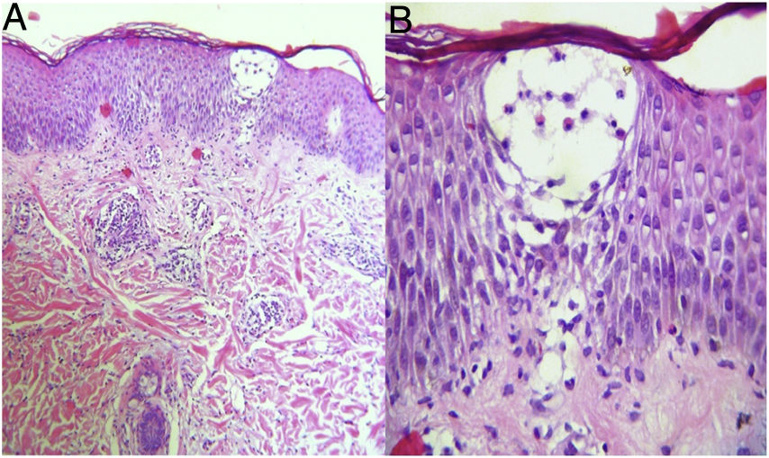 Pustulosis exantemática generalizada aguda asociada al embarazo | Piel ...
