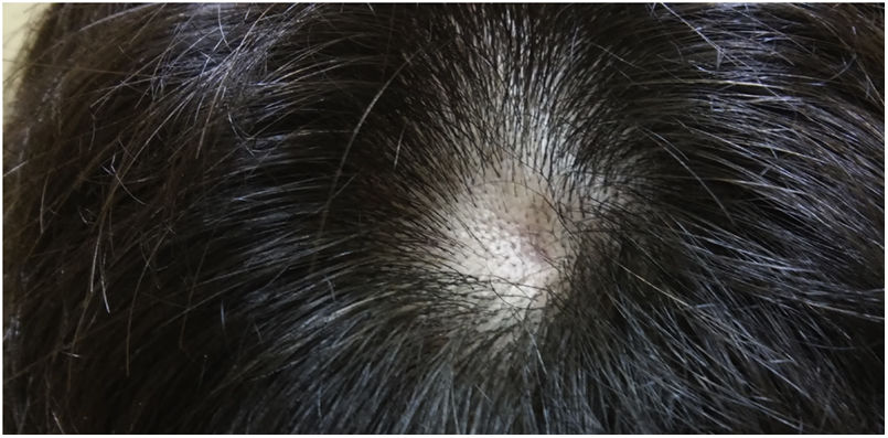 Nódulo alopécico en el cuero cabelludo | Piel. Formación continuada en ...