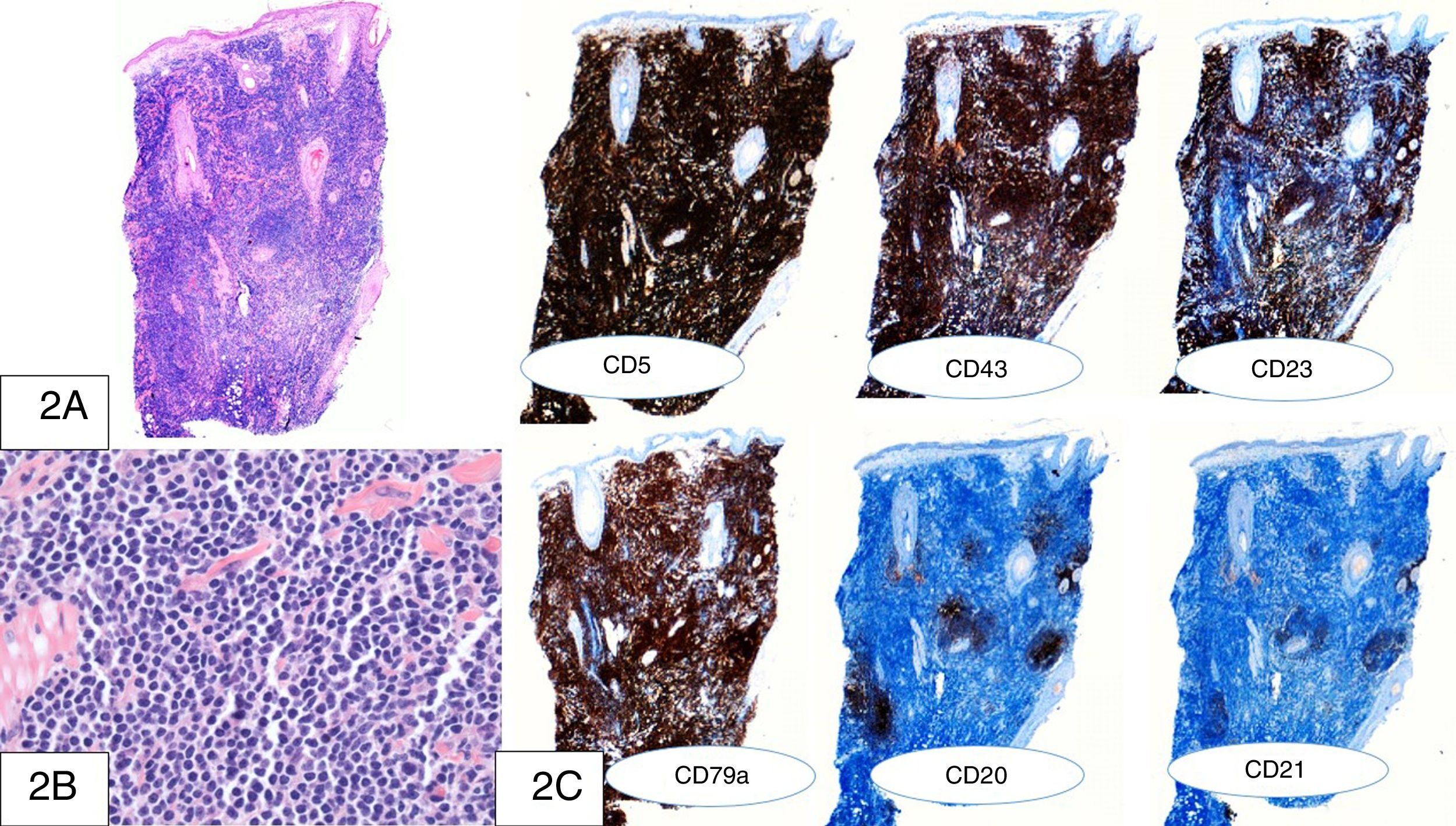Nódulo en cuero cabelludo tras aplicación de tinte azul | Piel ...